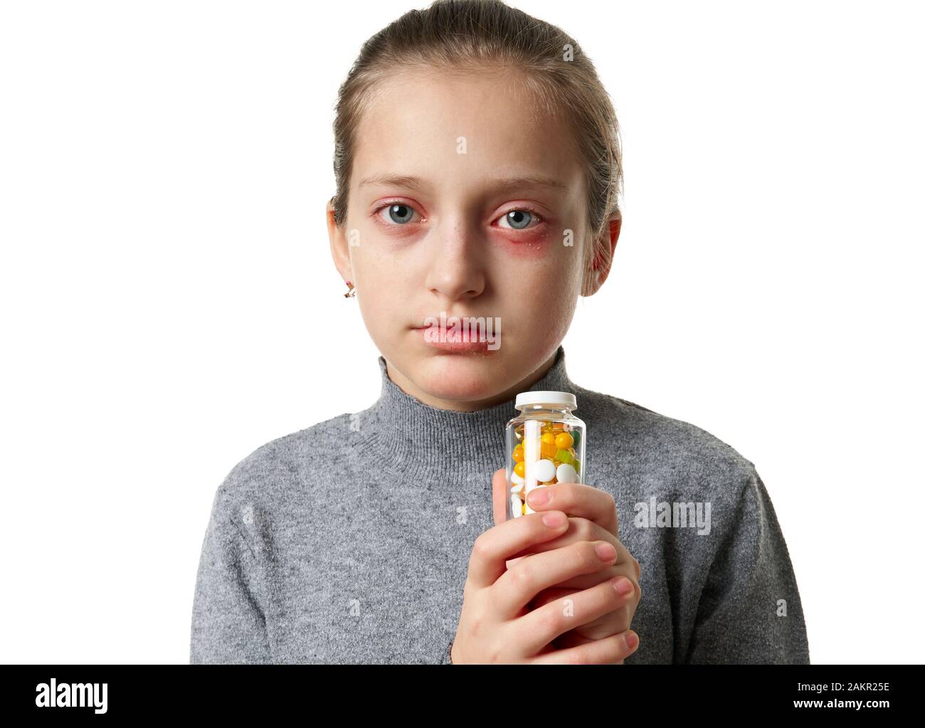 Réaction allergique, éruption de peau, fermer la vue portrait d'un ...