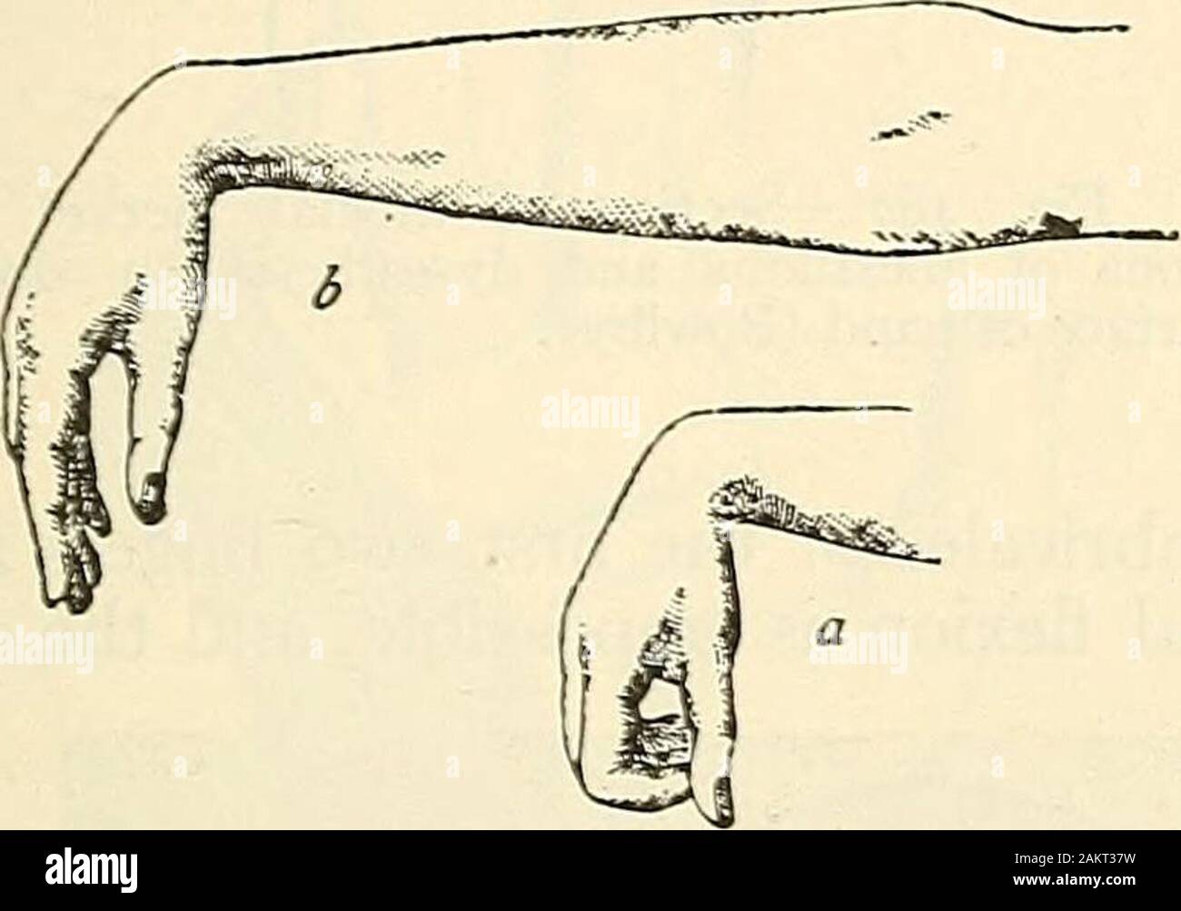 Radial nerve palsy Banque de photographies et d’images à haute ...