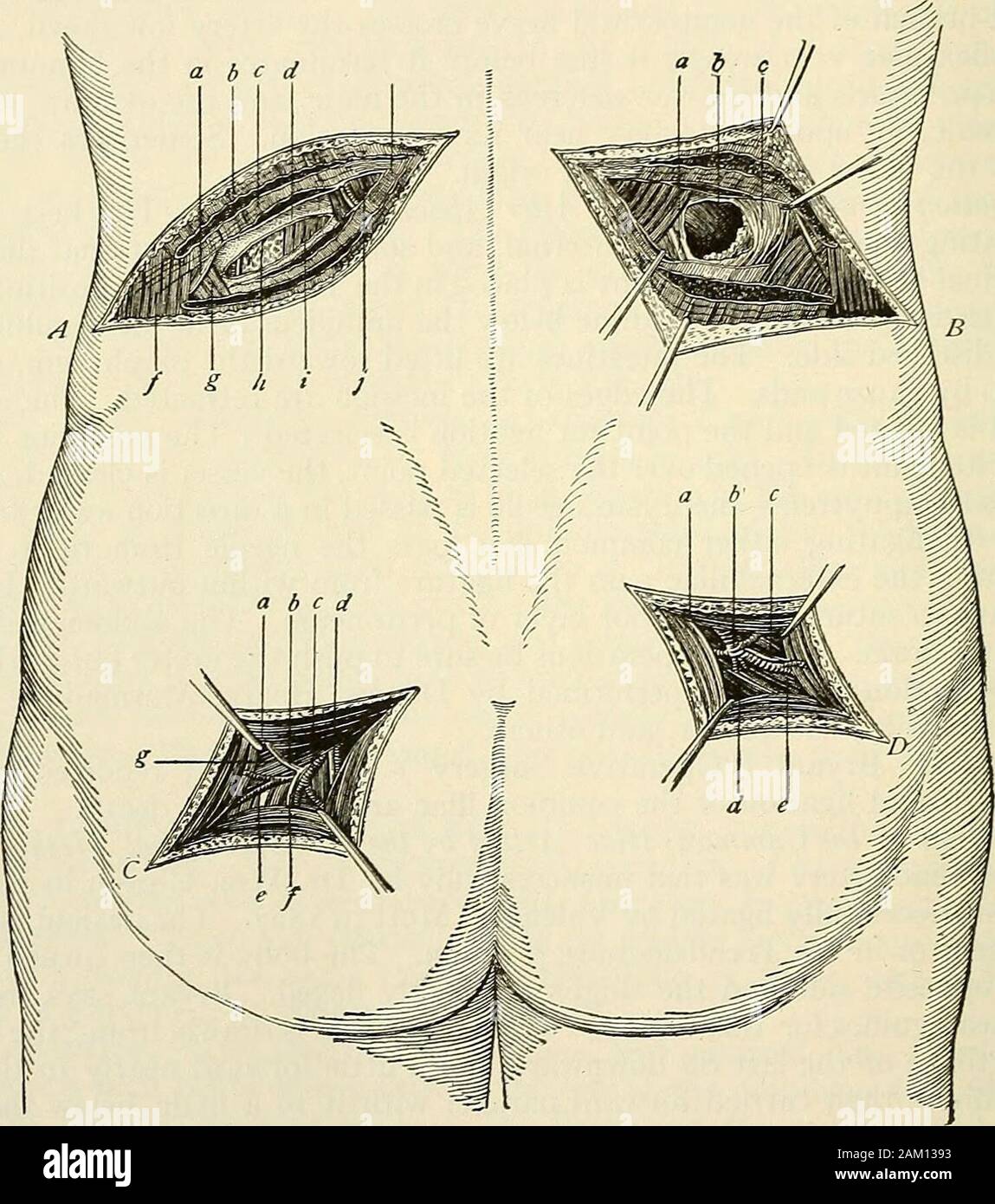 Muscle psoas iliaque Banque de photographies et d’images à haute ...