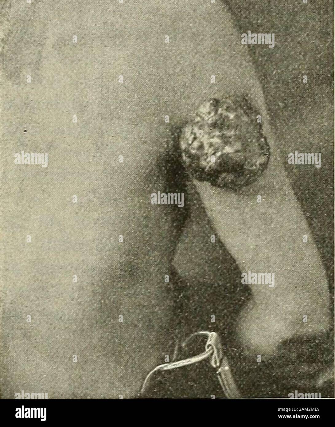 Kyste sébacé Banque de photographies et d’images à haute résolution - Alamy