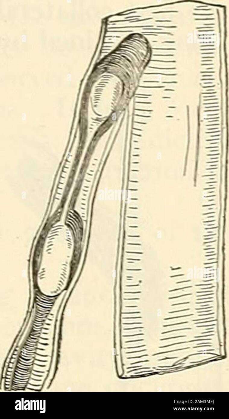 Destruction du caillot Banque de photographies et d’images à haute ...