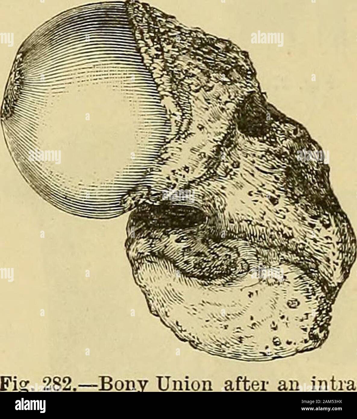Un système de chirurgie . éd. Disloca-tion du fémur sur le pubis de ...