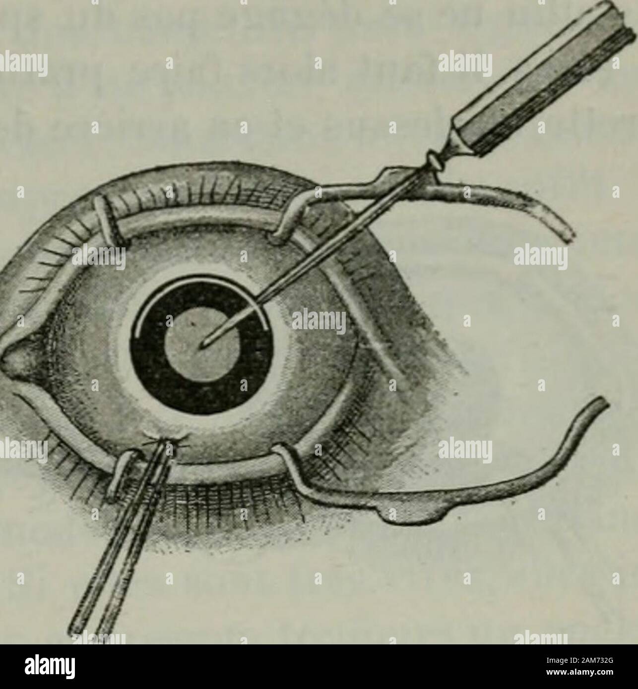 Traité de chirurgie . FiG. m. - Ponction et contre-ponctionavec le ...