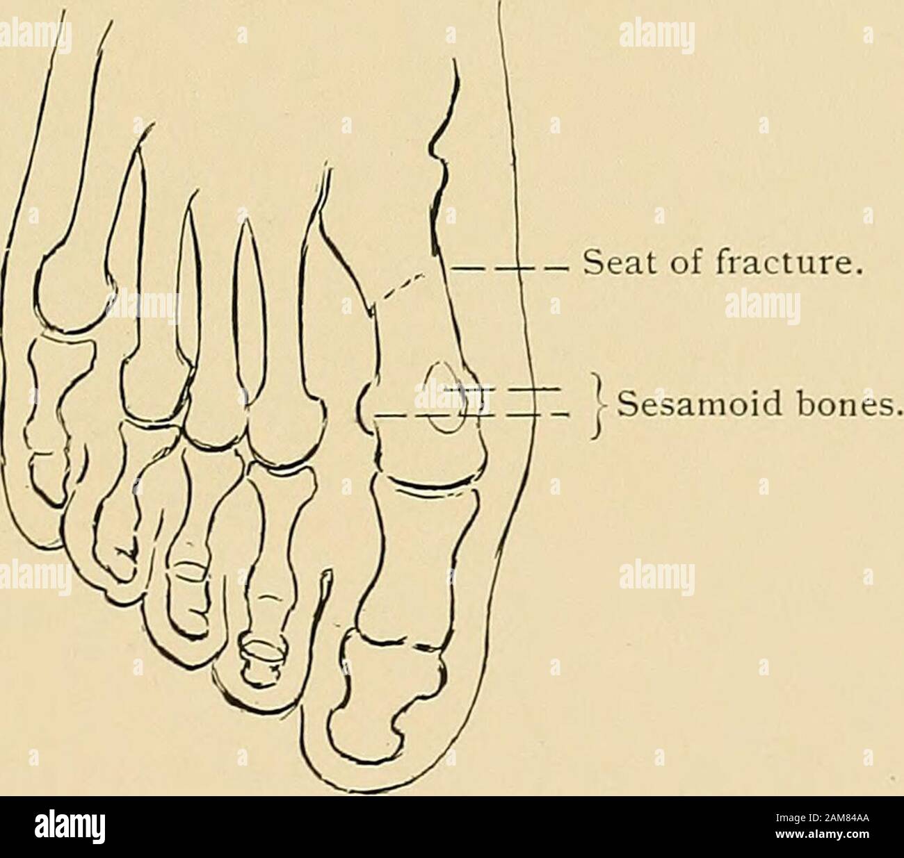 Le traitement des fractures . Fig. 565.-métatarse et phalanges ...