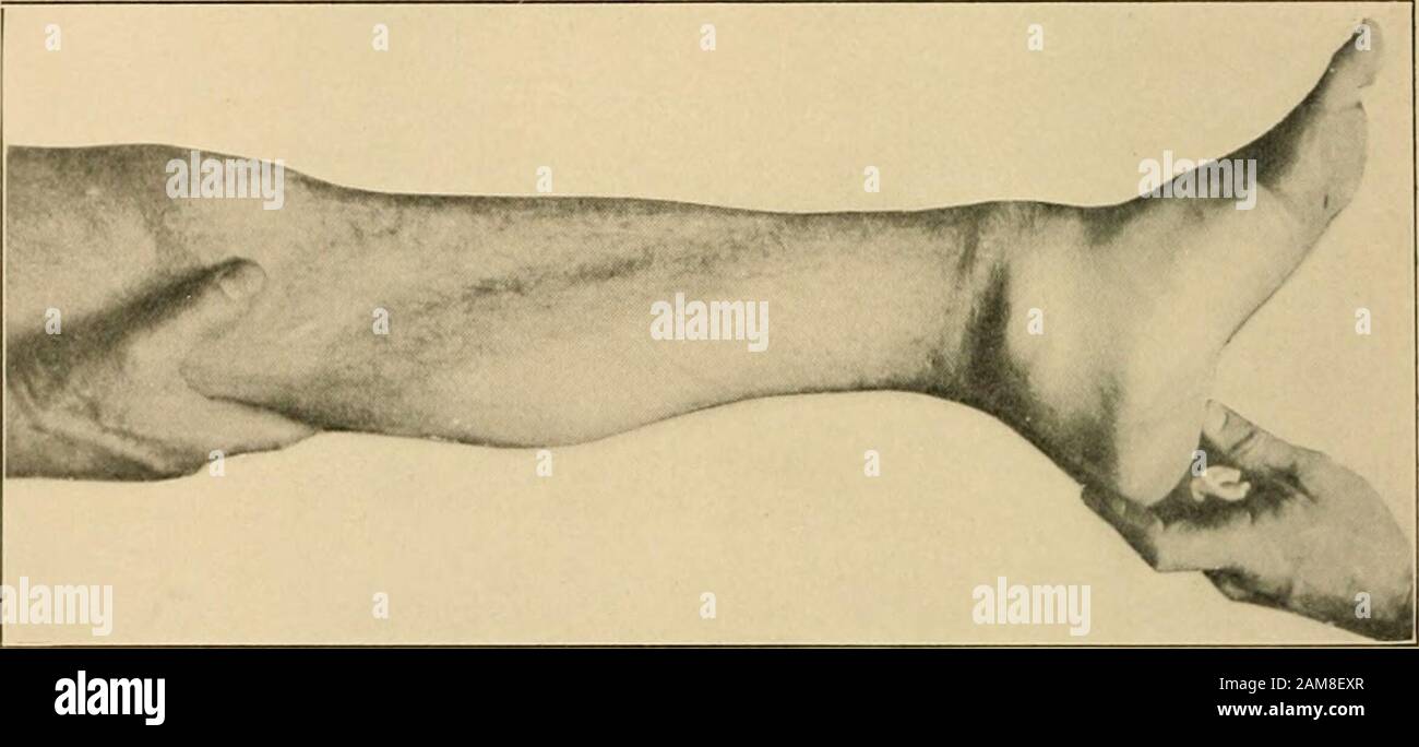 Nécrose pied Banque de photographies et d’images à haute résolution - Alamy