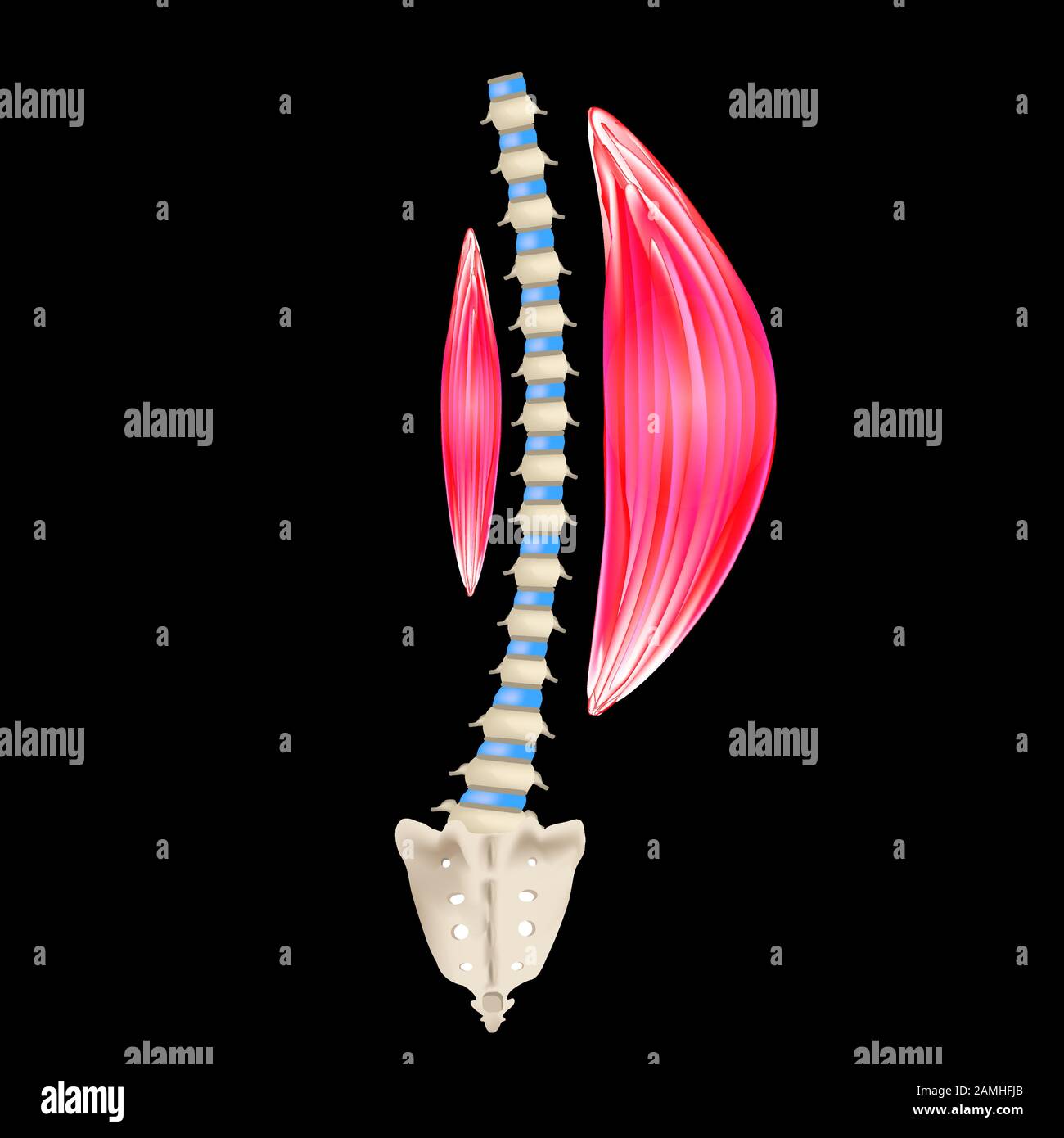 Scoliose du côté gauche. Lévocolisose. Muscles et colonne vertébrale ...