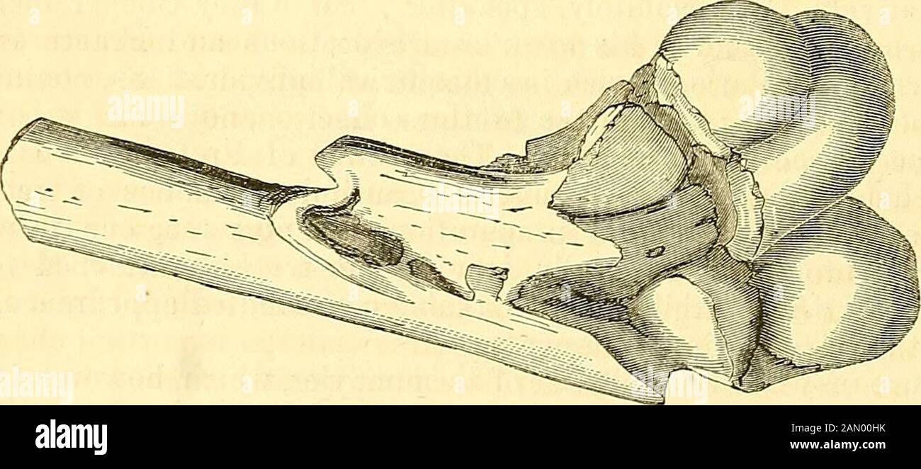Fracture pathologique Banque de photographies et d’images à haute ...