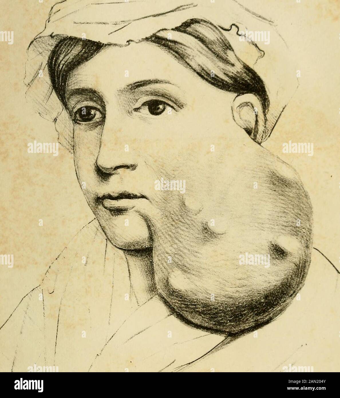 Maladies de la glande parotide et de la région parotidienne ...