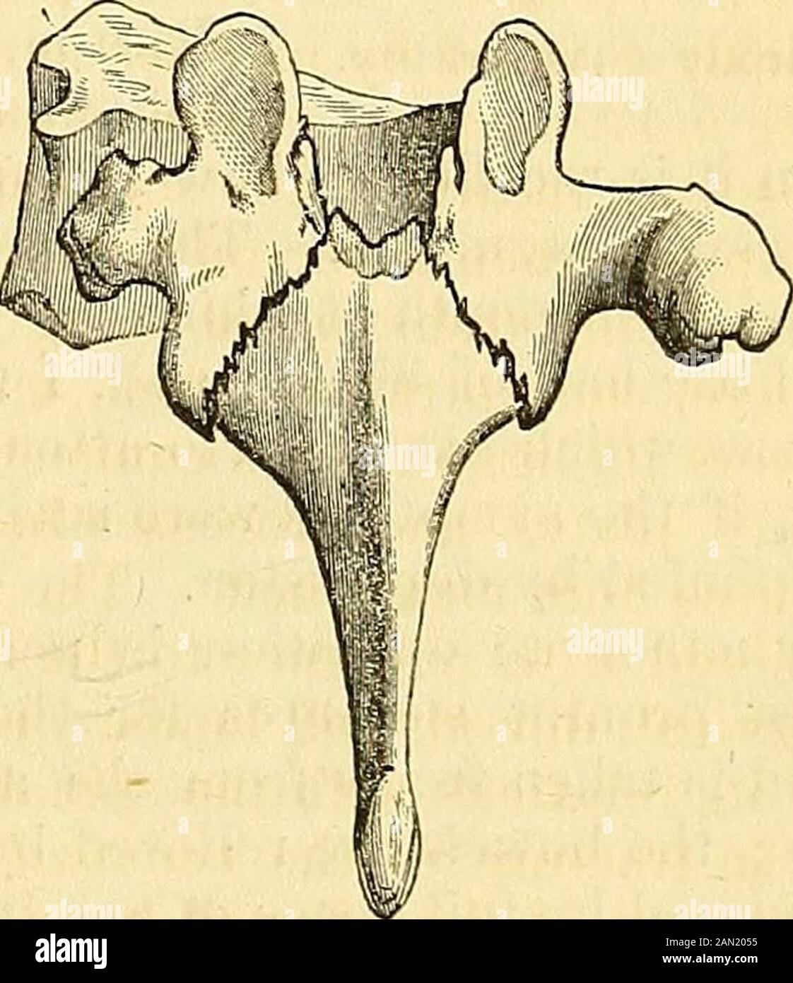 Fracture pathologique Banque de photographies et d’images à haute ...