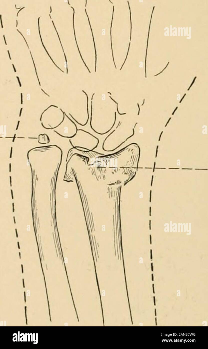 Le traitement des fractures . Ulna. Ligne de fracture. Fig. 298 ...