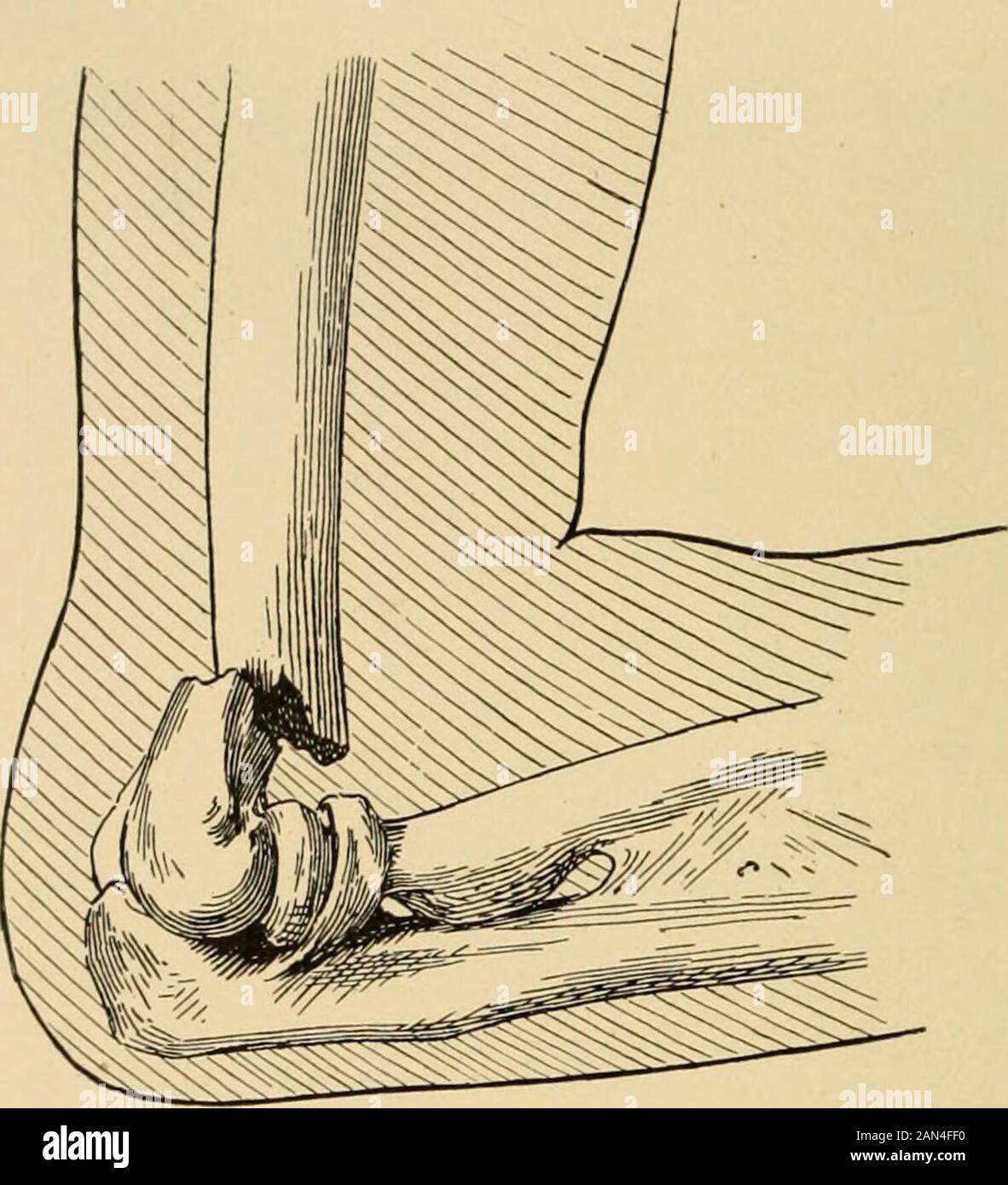 Fracture transversale Banque de photographies et d’images à haute ...