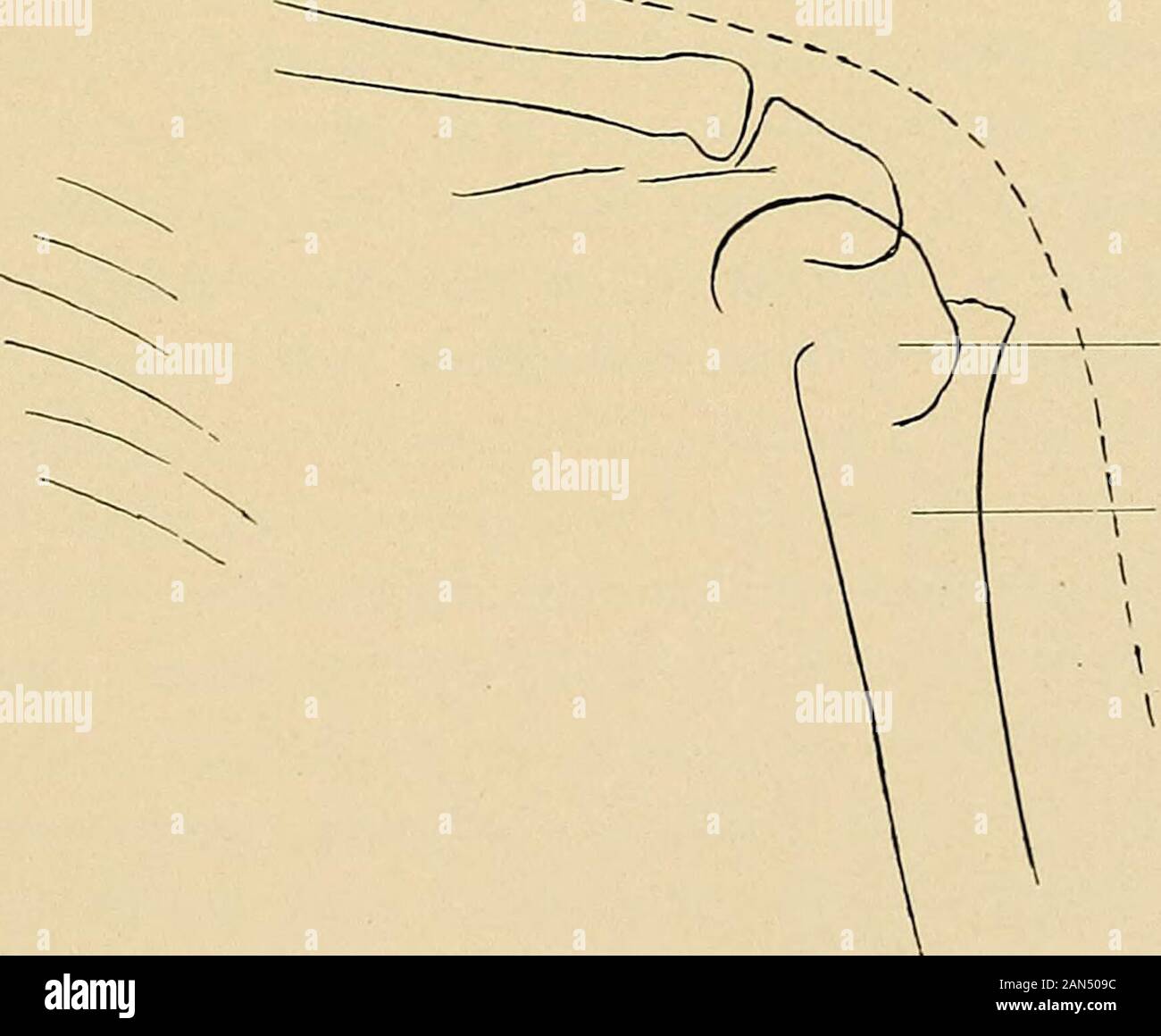 Humerus fracture de la tete Banque de photographies et d’images à haute ...