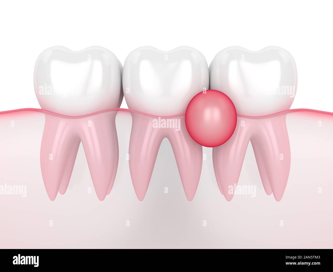 3D render de dents dans les gencives avec couronnes entre kyste sur ...