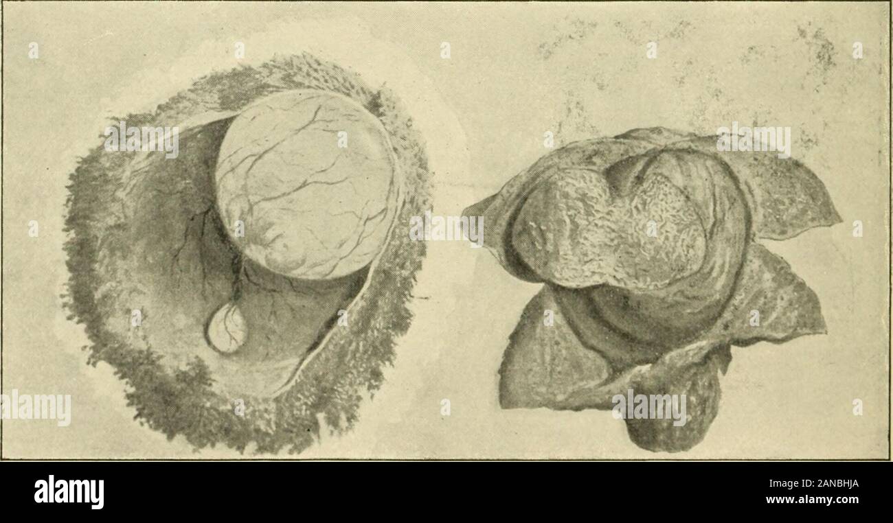 Bouchon muqueux Banque de photographies et d’images à haute résolution ...