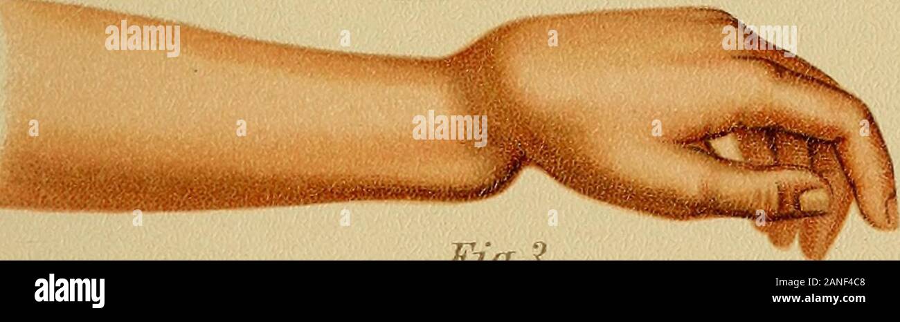 Atlas et exemple même de fractures et luxations traumatiques . Fjg.J ...