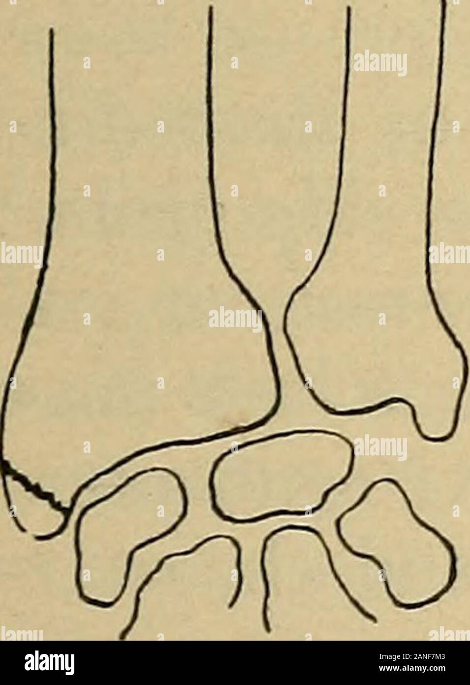 Atlas et exemple même de fractures et luxations traumatiques . Fig. 94 ...