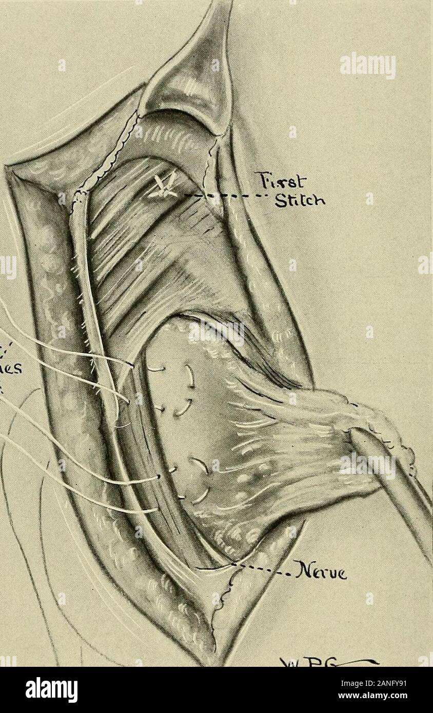 Points De Suture Résorbables Banque d'image et photos - Alamy