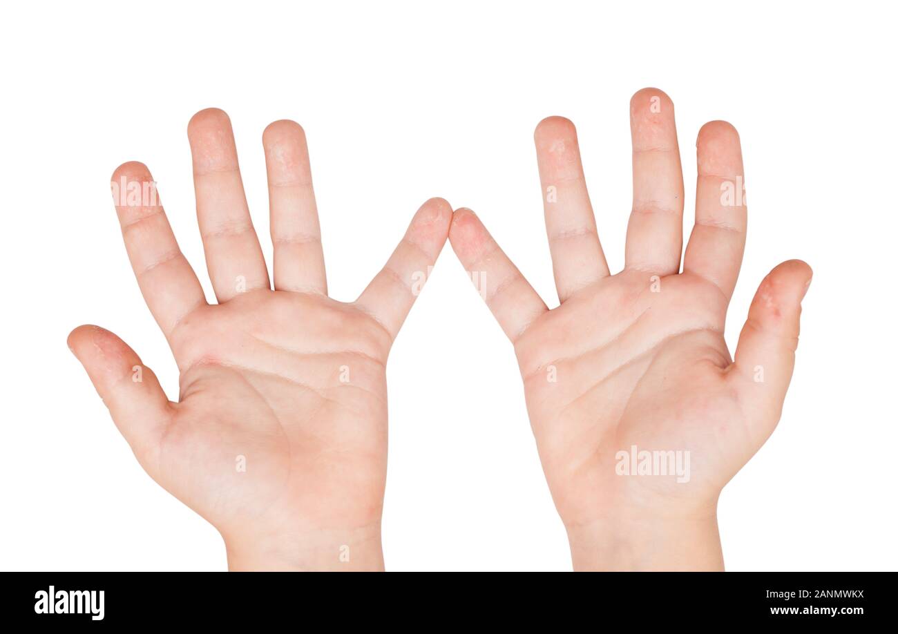 éruption de scarlatine Banque de photographies et d’images à haute ...