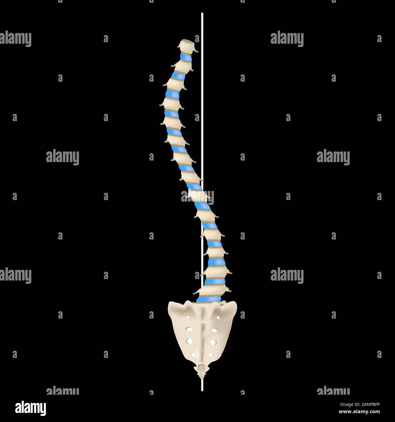 Lordose scoliose cyphose Banque de photographies et d’images à haute ...