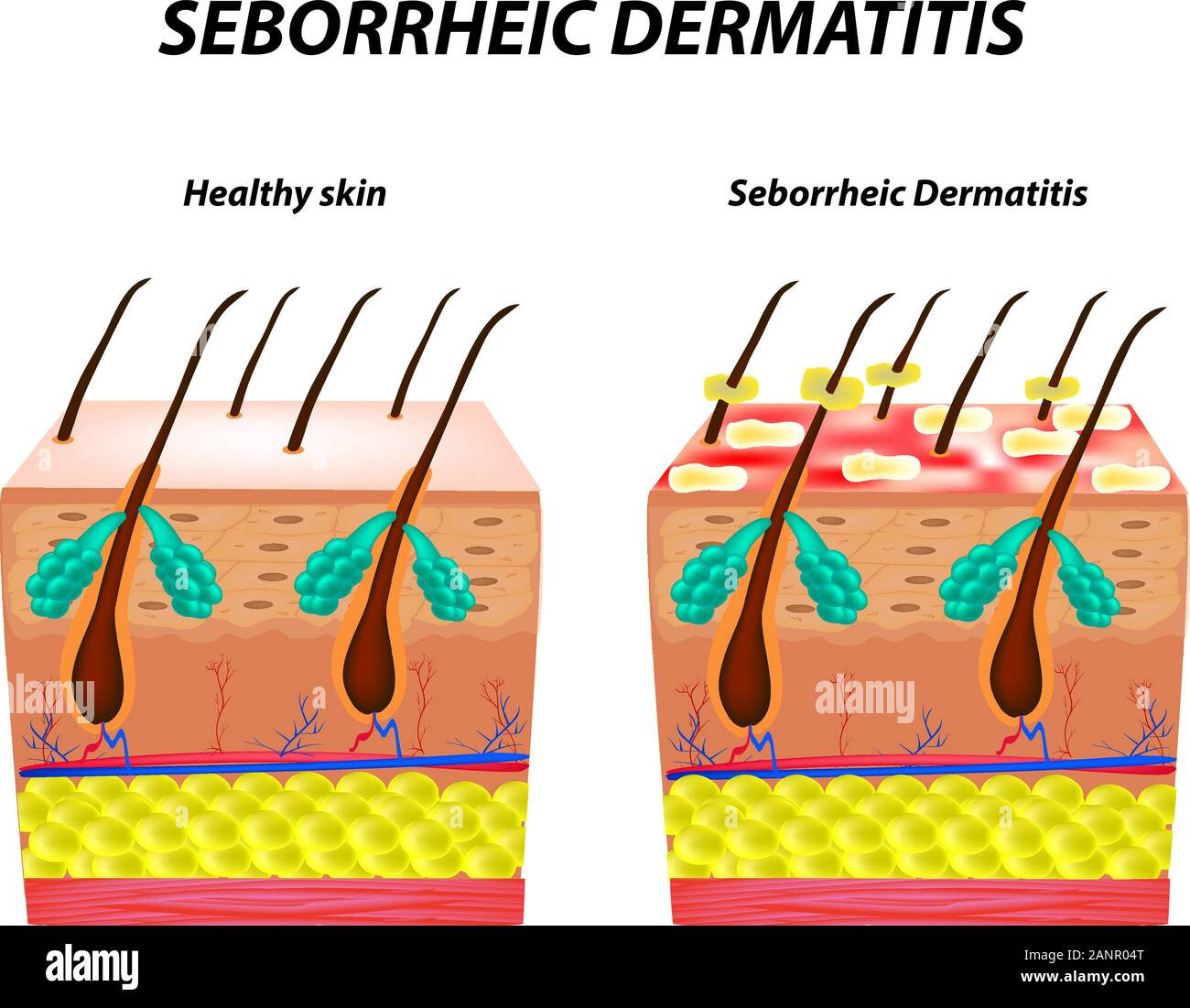 Dermatite séborrhéique du cuir chevelu Banque d'images détourées - Alamy