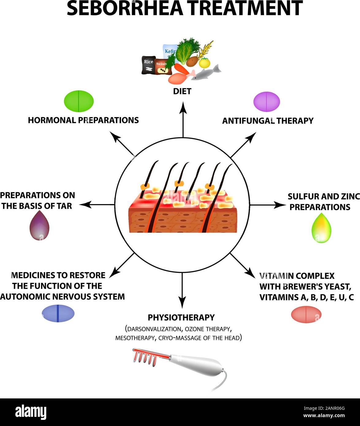 Dermatite séborrhéique du cuir chevelu Banque de photographies et d ...