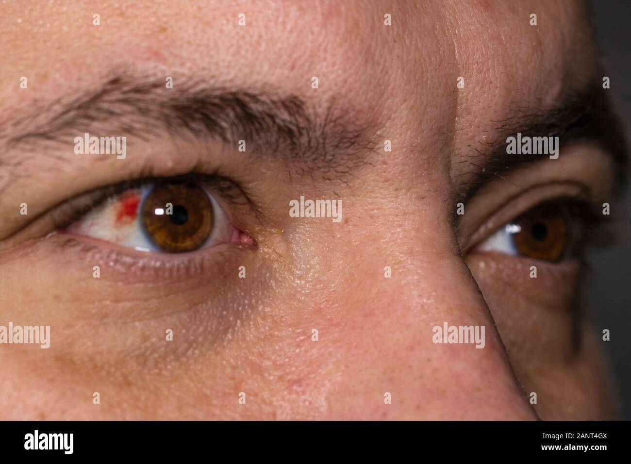 Vaisseaux Sanguins Oculaires Banque d'image et photos - Alamy