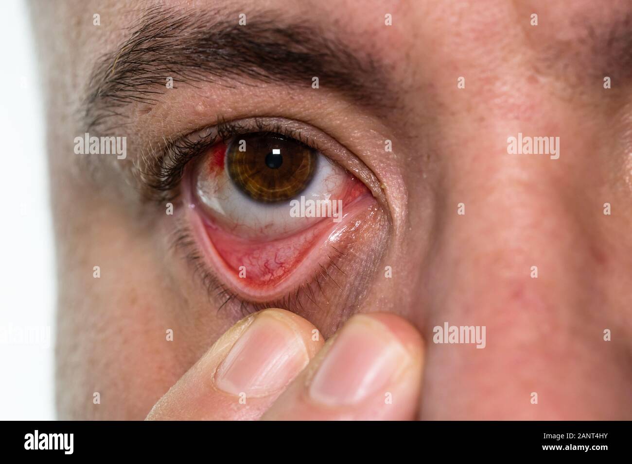 éclatement du vaisseau sanguin Banque de photographies et d’images à ...