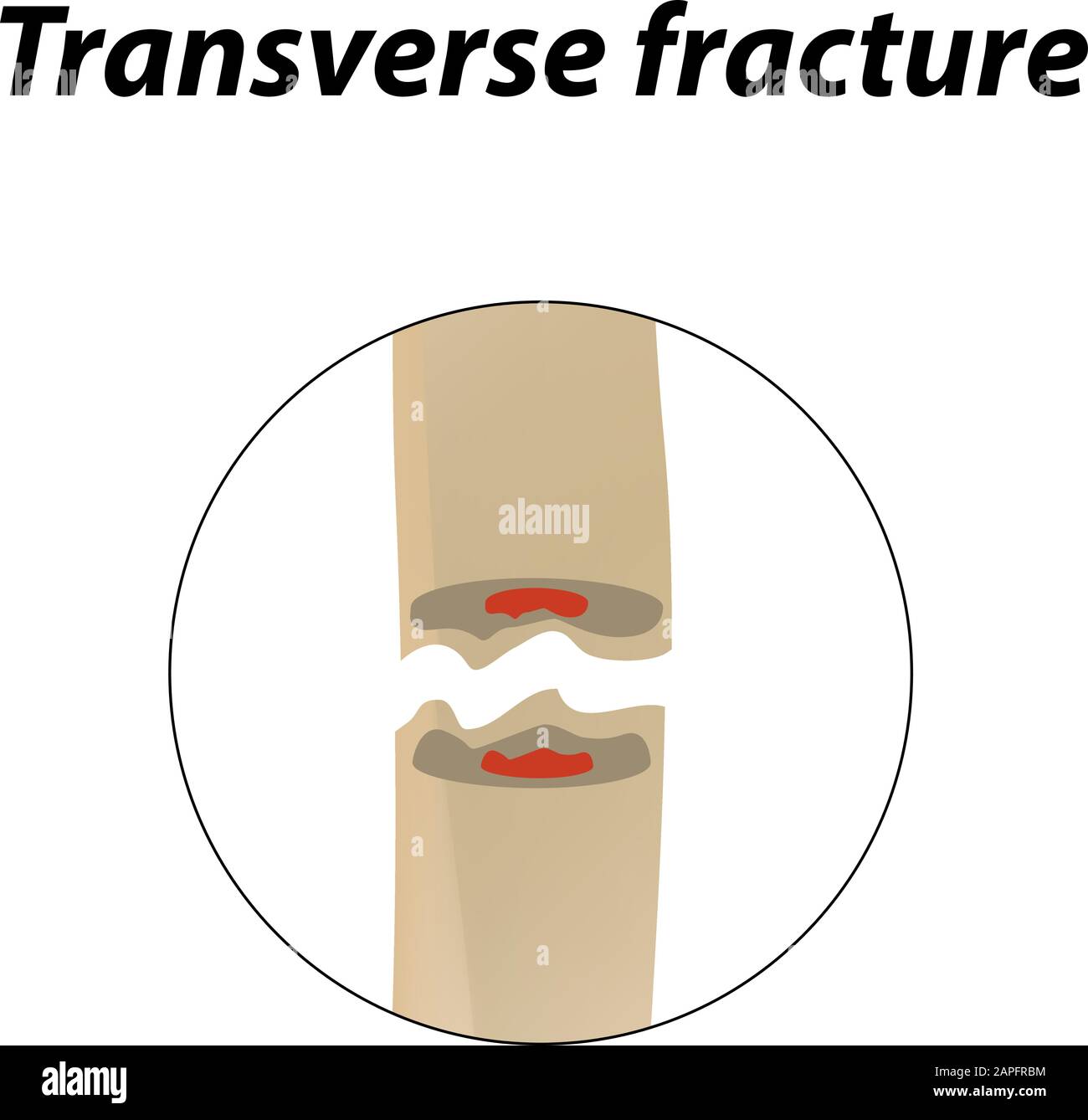 Fracture osseuse transversale. Infographies. Illustration vectorielle ...