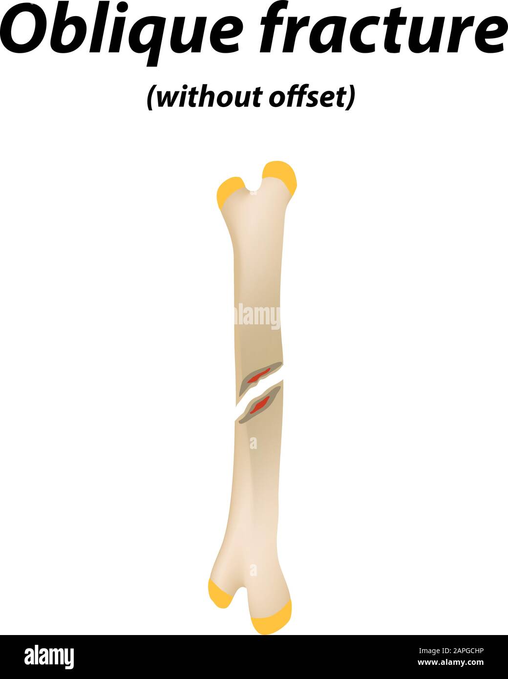 Transverse fracture Banque d'images vectorielles - Alamy