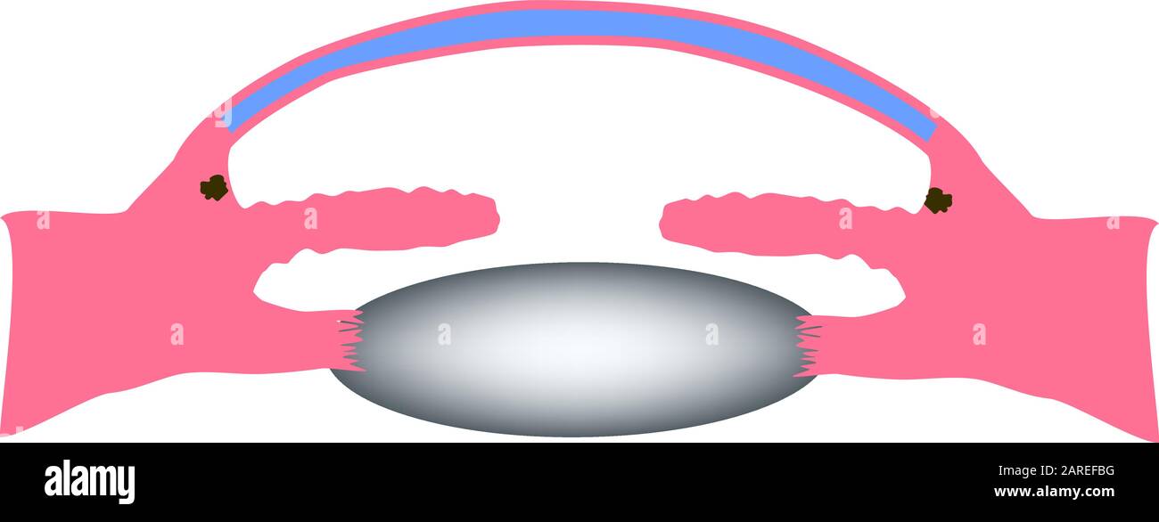 Glaucome à angle ouvert. Un type commun de glaucome. Structure ...