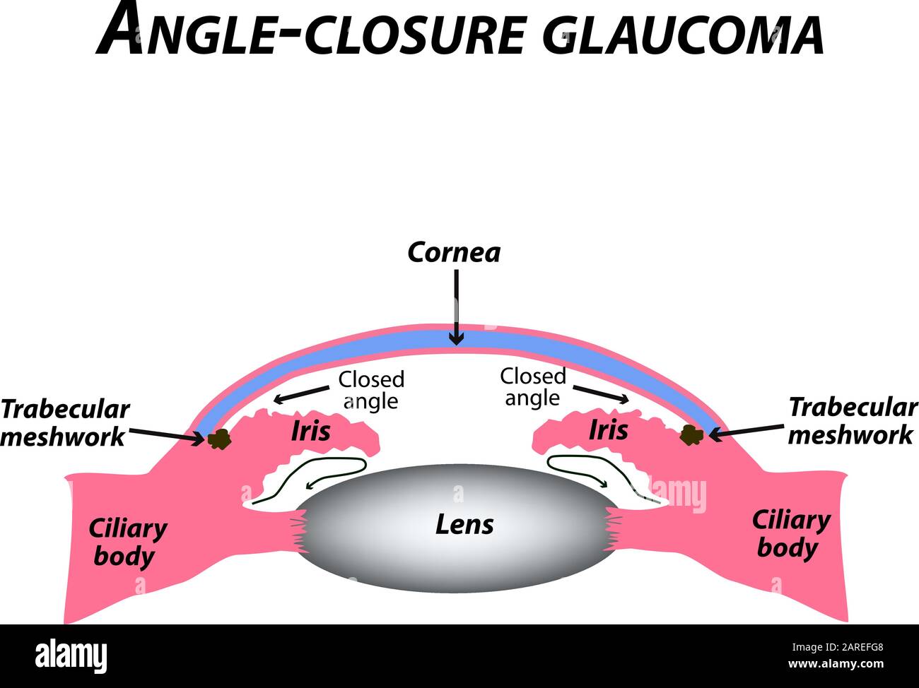 Glaucome à angle fermé. Un type commun de glaucome. Structure ...