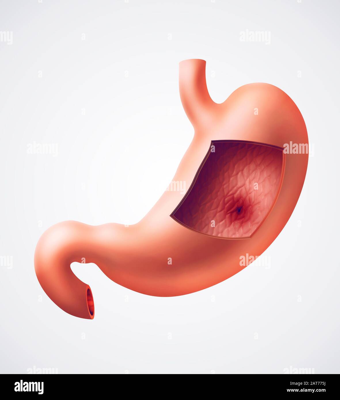 Ulcere gastrique Banque de photographies et d’images à haute résolution ...