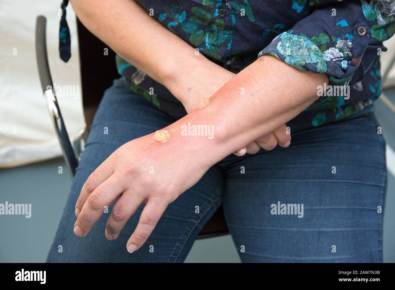 Brûlure au deuxième degré traitement Banque de photographies et d ...
