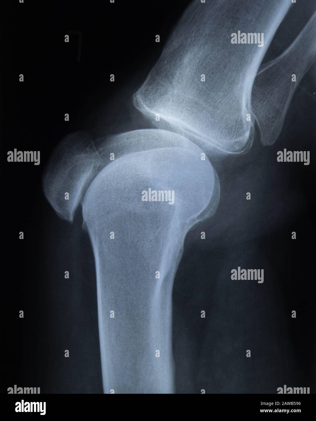 Genou valgus Banque de photographies et d’images à haute résolution - Alamy