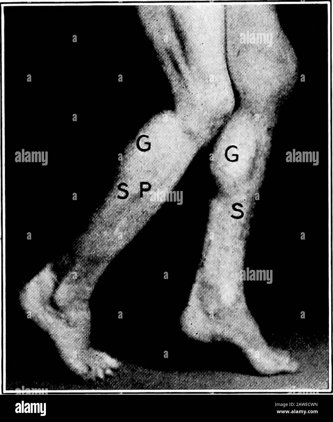 Muscle long fibulaire Banque d'images noir et blanc - Alamy