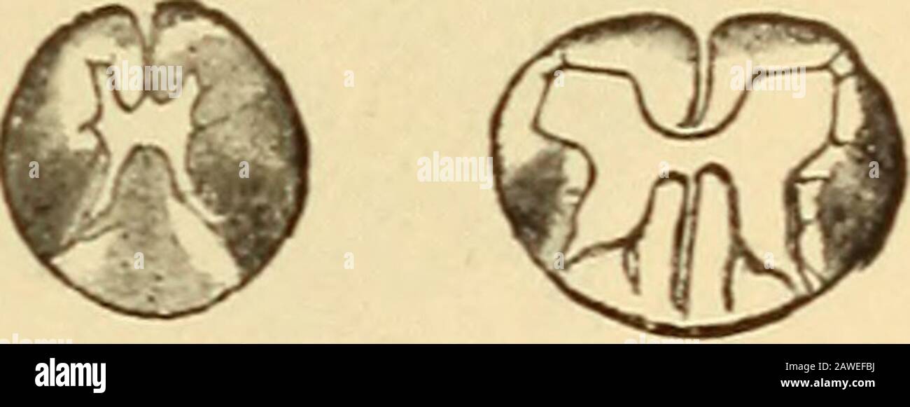Maladies du système nerveux .. . Fig. 118.—Transvers Myélitis avec ...