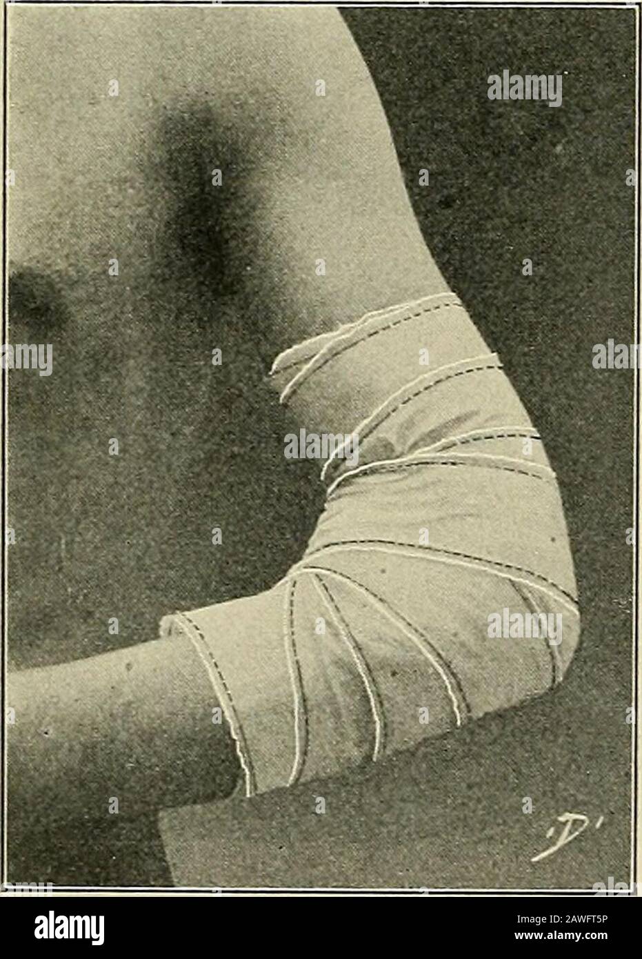 Desault bandage Banque de photographies et d’images à haute résolution ...