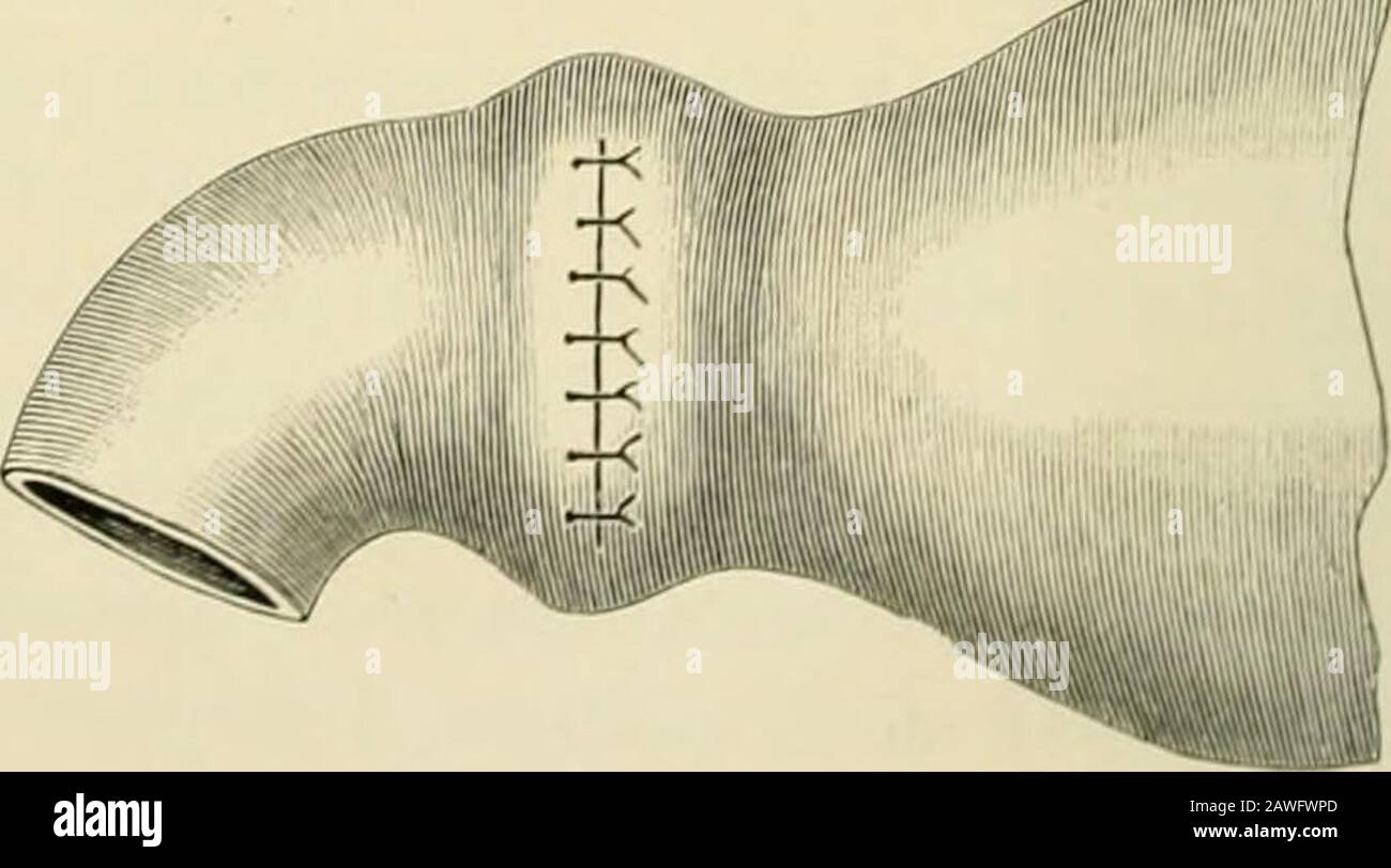 Chirurgie opératoire . Porc. 996.—le fonctionnement de la pyloroplastie ...