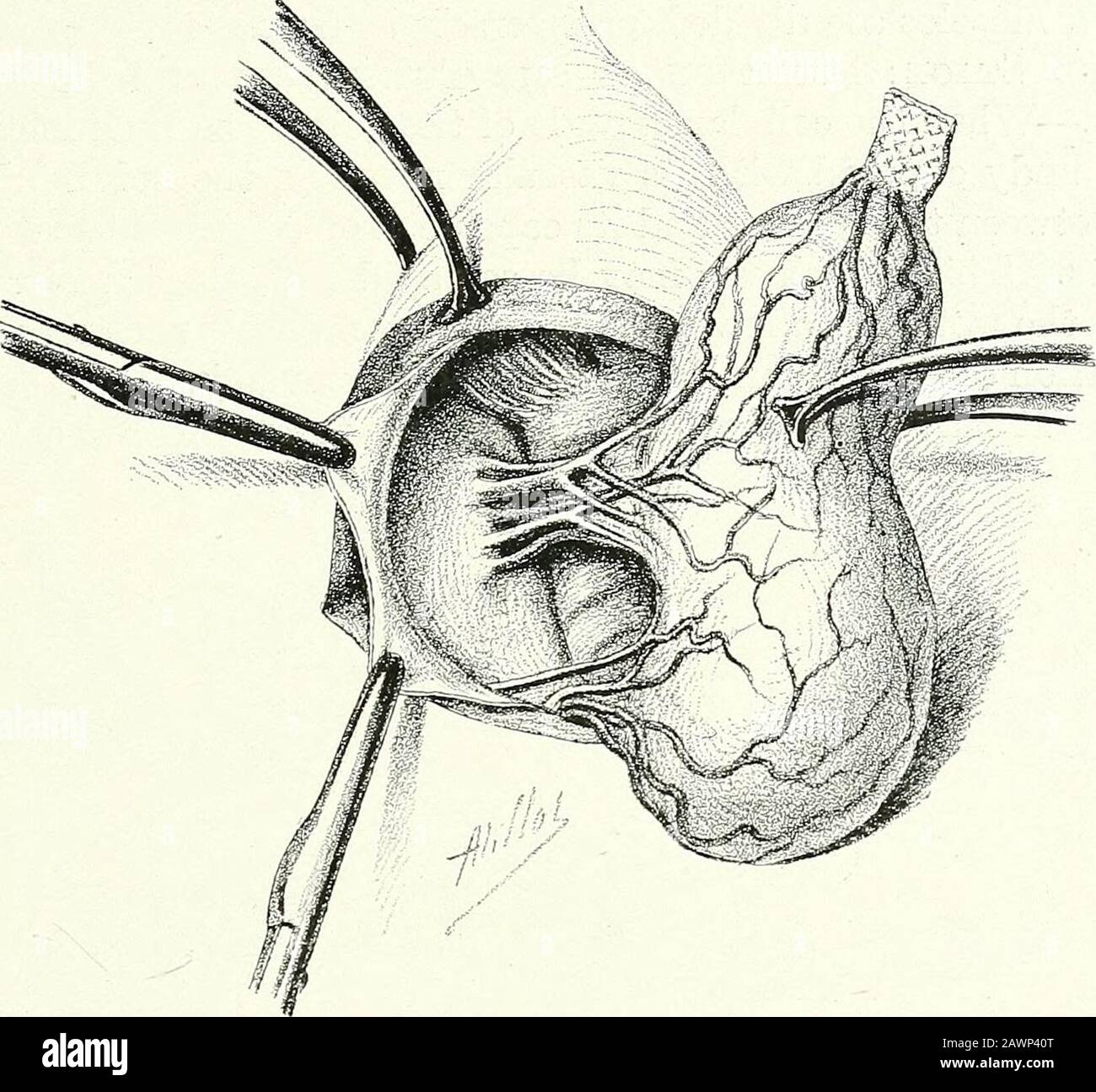 Thérapeutique chirurgicale et technique opératoire . Fig. 339 ...