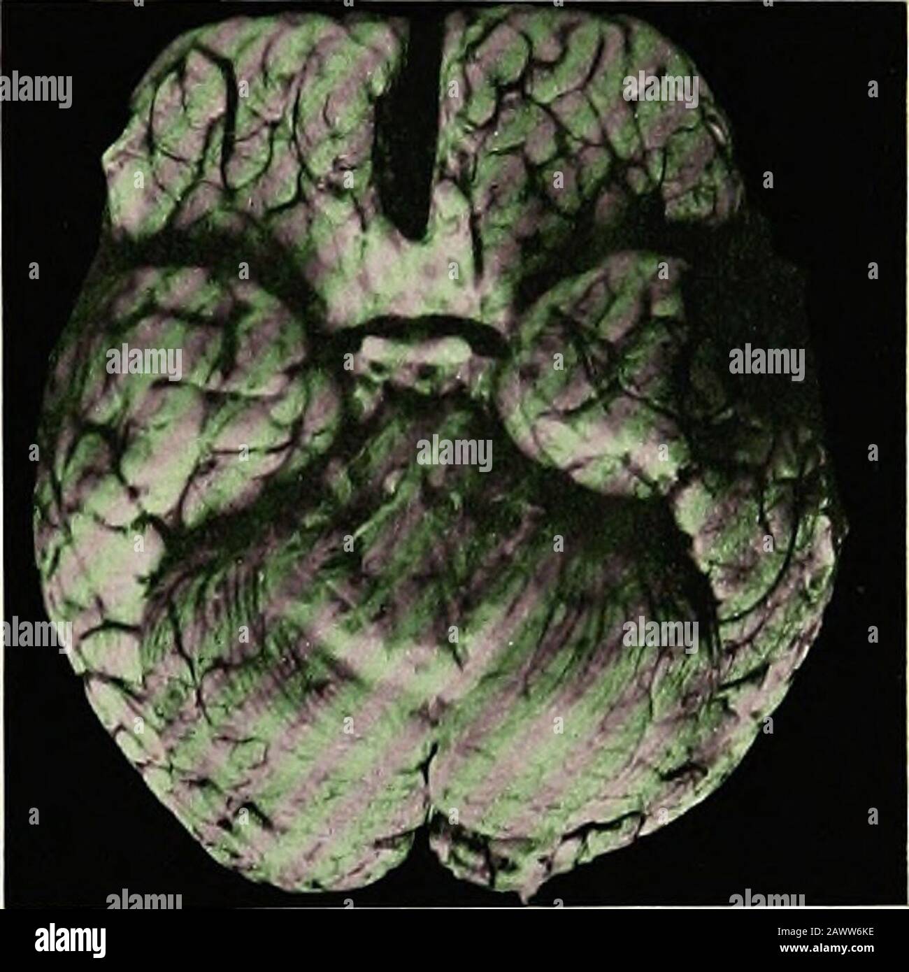 Les maladies médicales des enfants . y indique la méningite. Les abcès ...