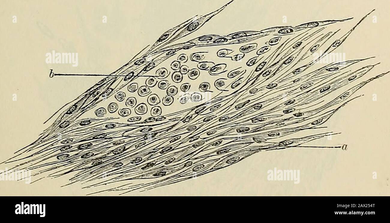 Tumeurs à cellules fusiformes Banque de photographies et d’images à ...