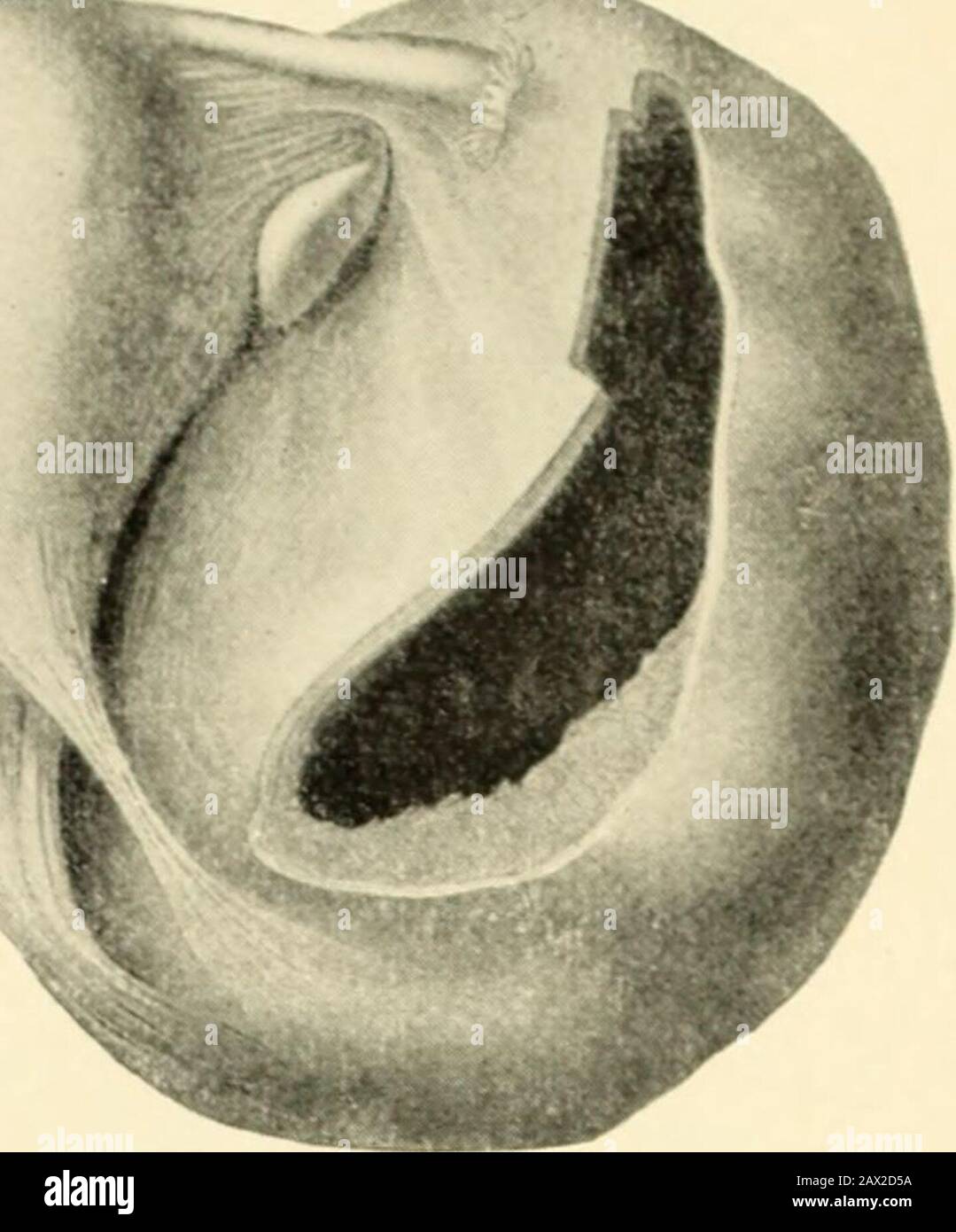 Un manuel d'obstétrique . Fig. 162.—grossesse De ligament Large ...