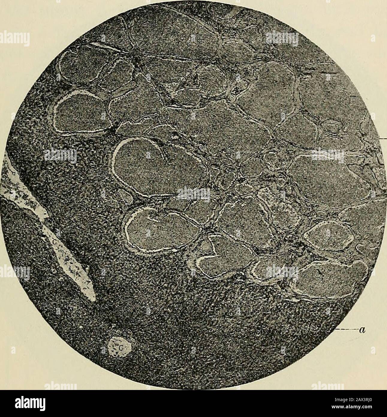 Tumeur d'angiome Banque de photographies et d’images à haute résolution ...