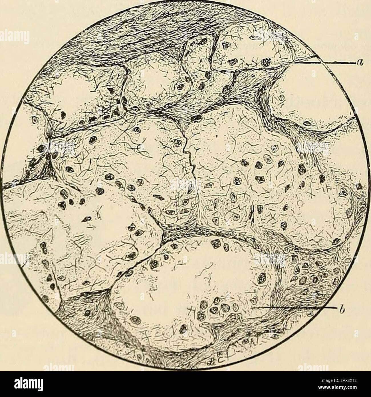 La pathologie et le traitement chirurgical des tumeurs . Fig. 315 ...