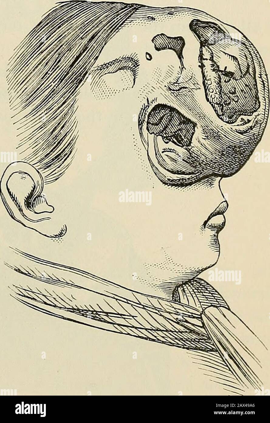 Nécrose cutanée Banque de photographies et d’images à haute résolution ...
