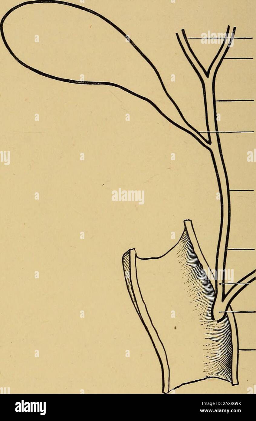 Les calculs biliaires et les maladies des canaux biliaires . Fig. 1 ...