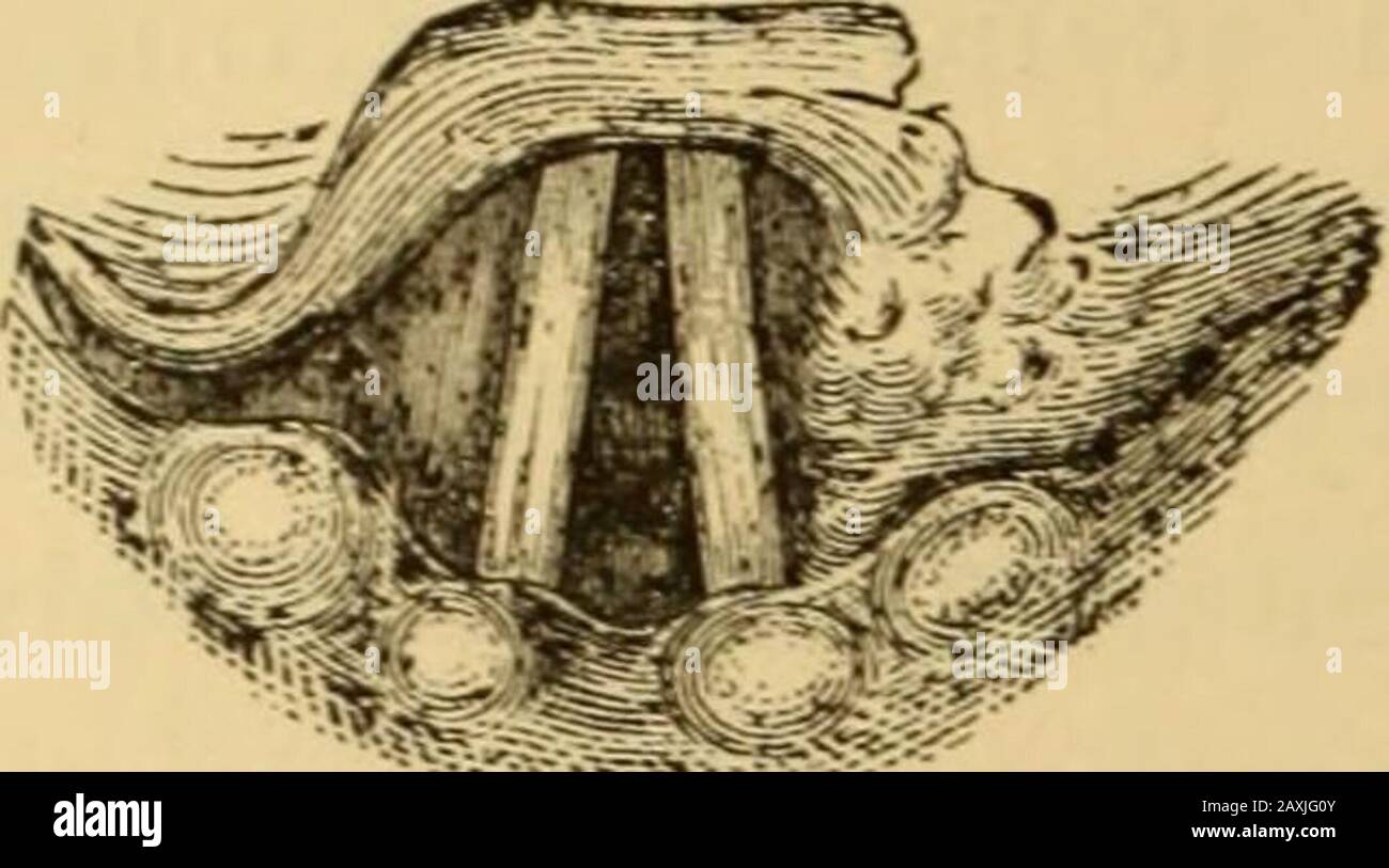 Chancre syphilitique Banque de photographies et d’images à haute ...