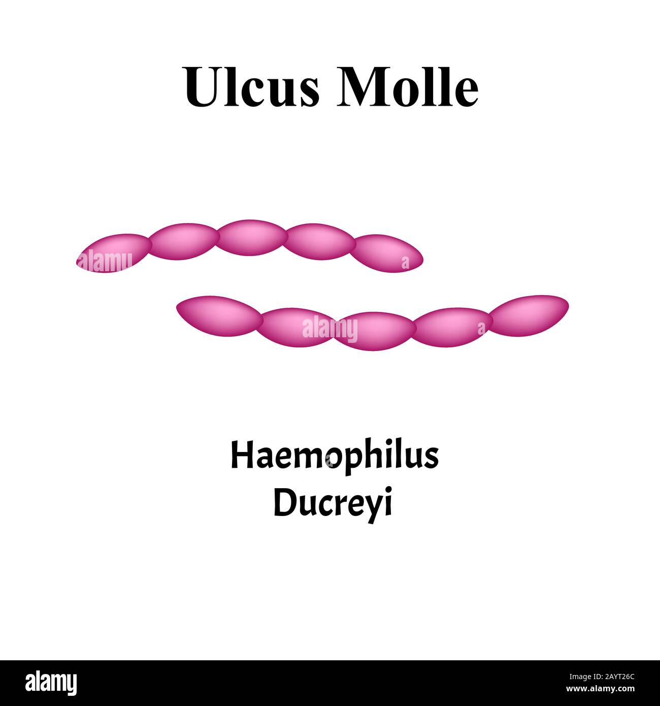 Ulcus Molle, Haemophilus Ducreyi. Infections bactériennes. Maladies ...
