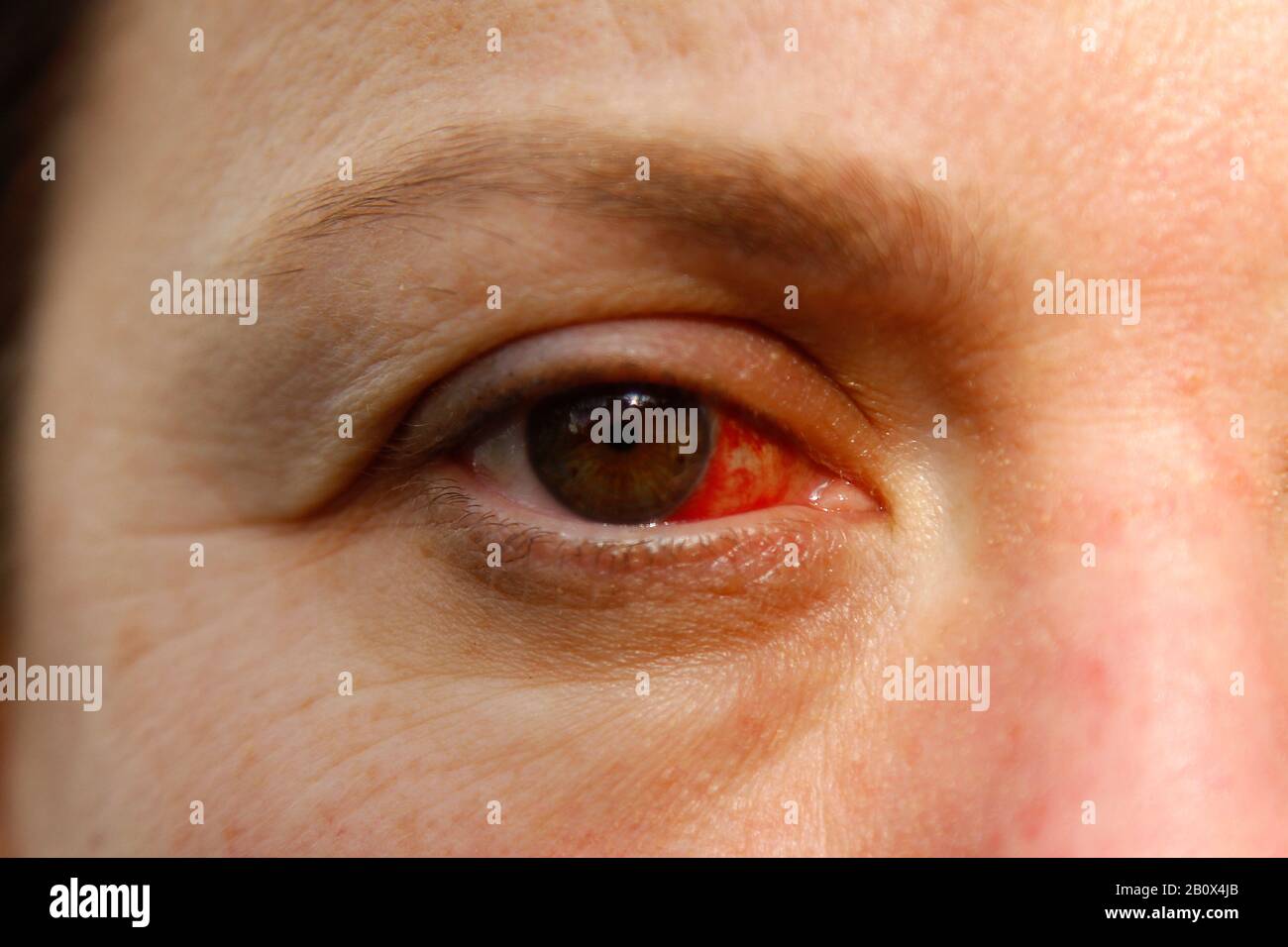 Conjunctivitis veins Banque de photographies et d’images à haute ...