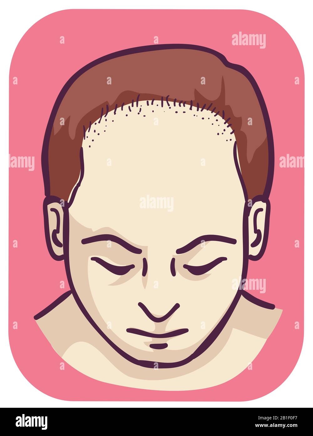 Illustration D'Un Homme Montrant La Calvitie Masculine, La Perte ...